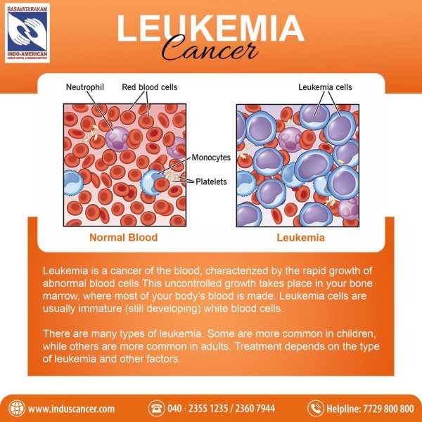 Comprehensive Guide to Leukemia: Symptoms, Causes, Treatment, Types ...