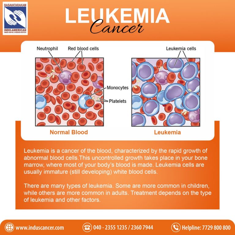Comprehensive Guide to Leukemia: Symptoms, Causes, Treatment, Types ...